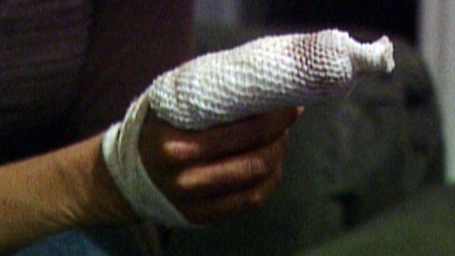 Woman's Finger Allegedly Bitten Off | Fox News Video